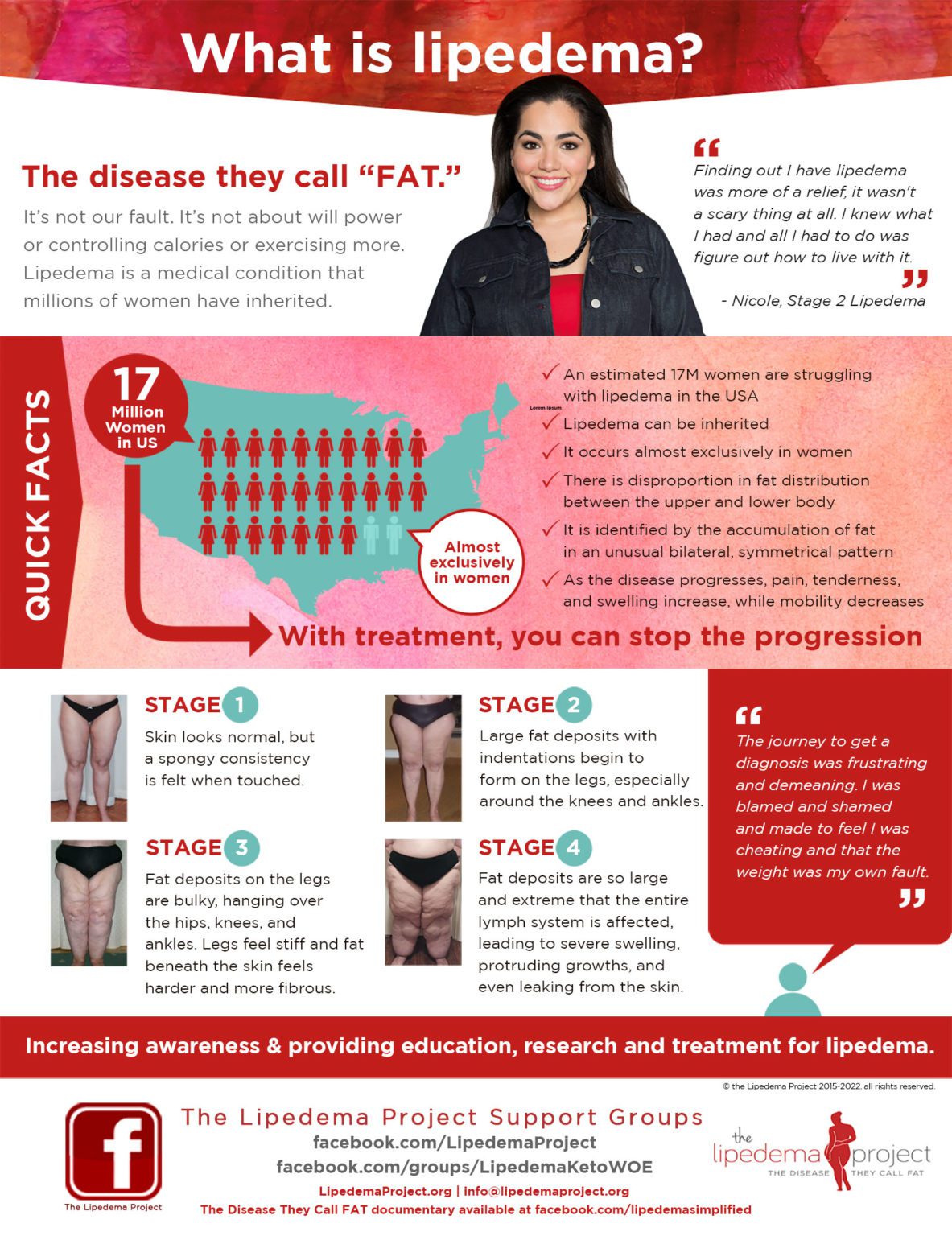 Lipedema-INFOGRAPHIC-TLP-INC-2021 - Lipedema Simplified